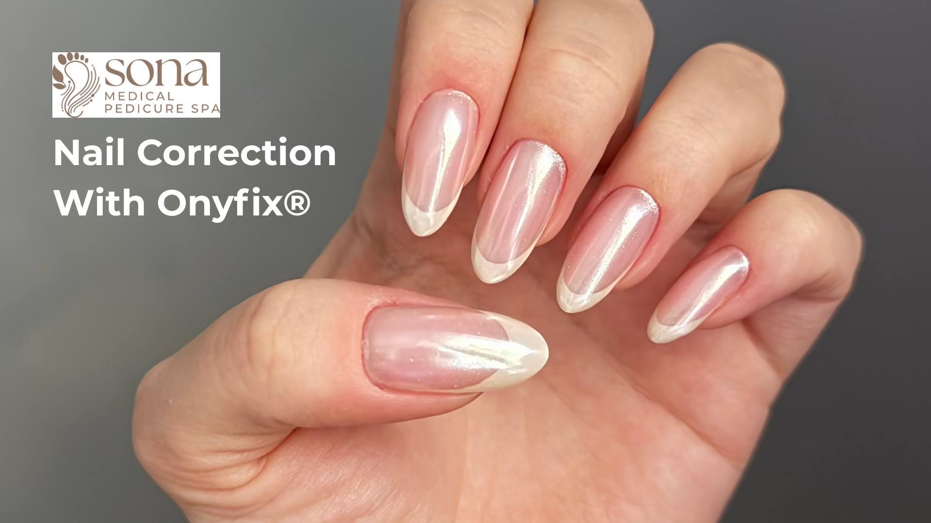 Onyfix® Nail Correction